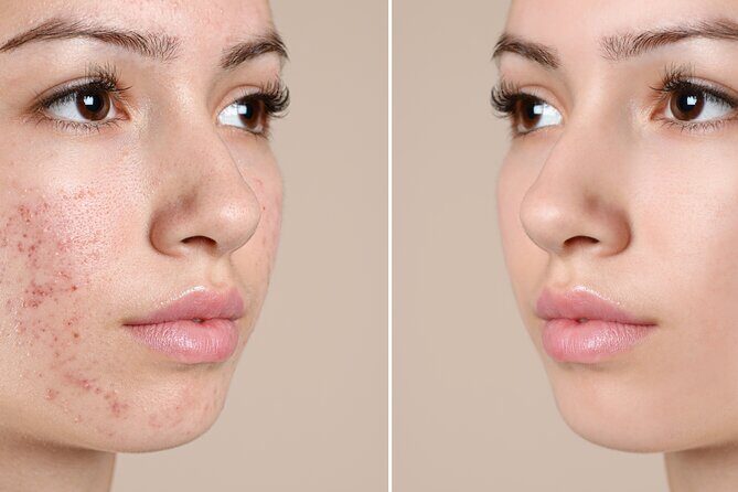 Skin Glo Package w/microderm/LED- For 2 with Appetizers and Wine - Additional Notes